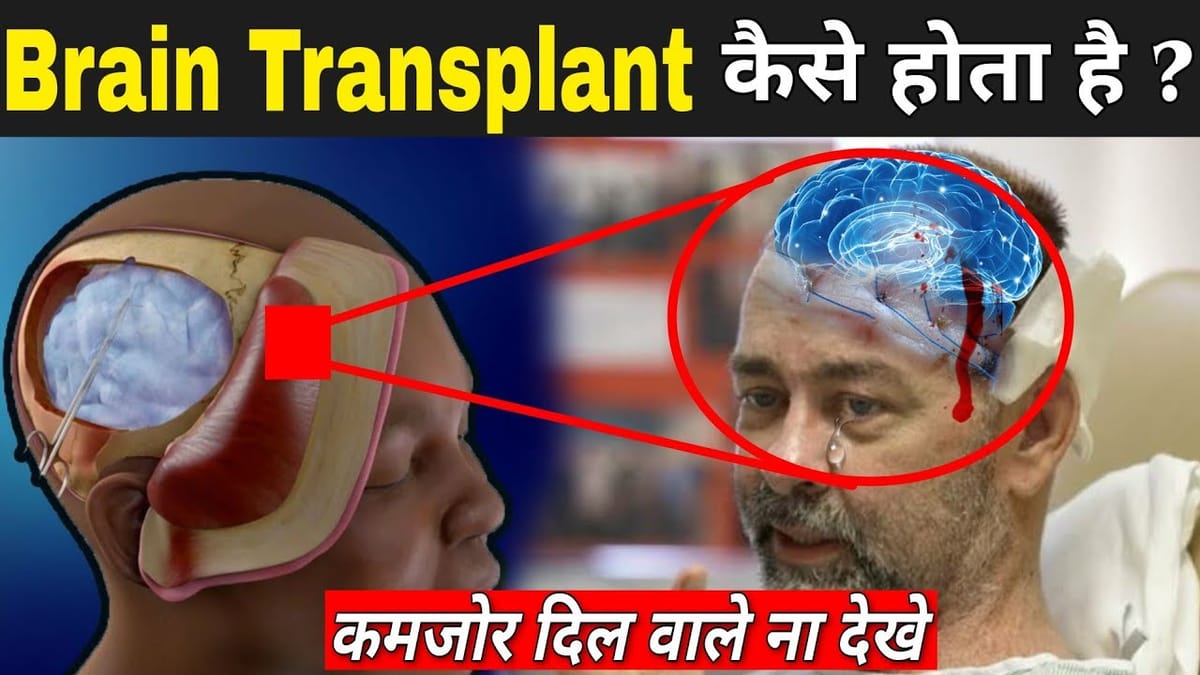 head transplant surgery:अब सिर को भी बदला जा सकता हैं?सिर के ...
